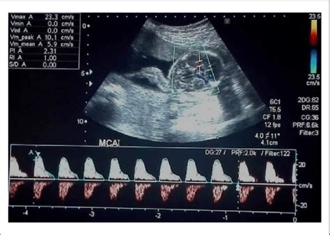 Spectral Doppler Waveform Of The Fetal Middle Cerebral Artery