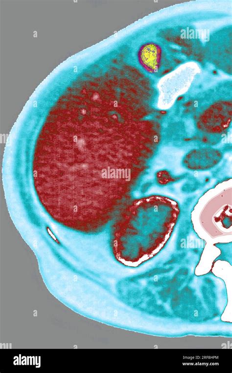 Lymphoma Revealed By Lymphadenopathy Between The Liver And The