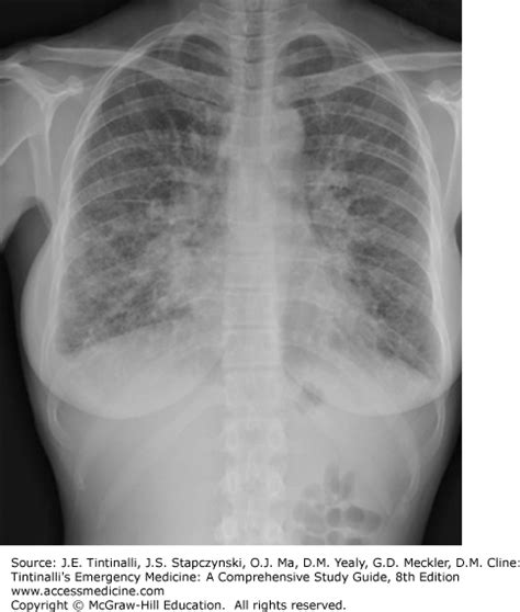 Pneumonia And Pulmonary Infiltrates Anesthesia Key