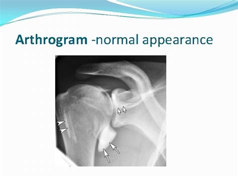 Shoulder Arthrography Outline Anatomy Arthrogram Introduction Indications Contraindications