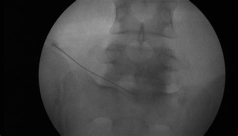 Did Another Sup Hypogastric Plexus Neurolysis