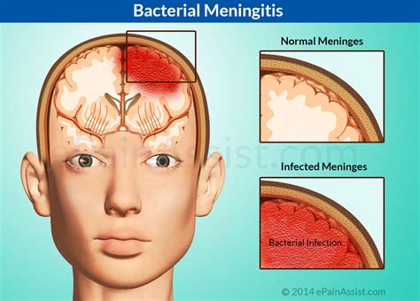 Meningitis At Emaze Presentation