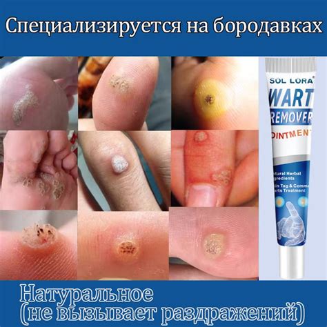 Средство от папиллом и бородавок для удаления бородавок папиллом сухих мозолей на ногах и теле
