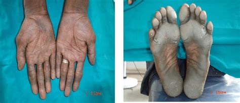 Palms And Fect Showing Keratinisation Download Scientific Diagram