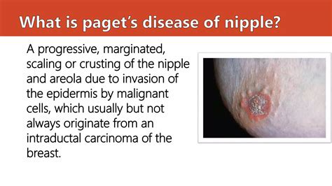 Pagets Breast Symptoms Photo Pagets Disease Breast Cancer Qeqrw