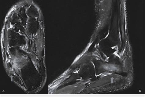 Preoperative Mri Depicting An Osseous Lesion Accompanied By Diffuse Download Scientific Diagram