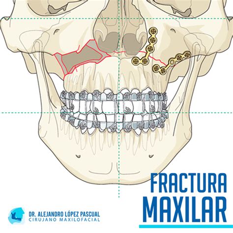 La Fractura Del Maxilar Es Directorio Indipensable