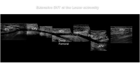 Lower Extremity Venous Duplex Protocol Sonographic Tendencies