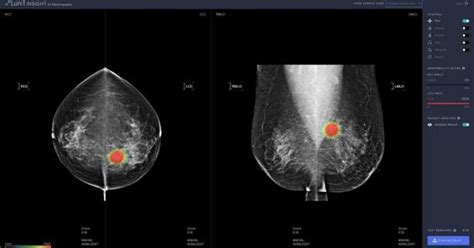 암 진단부터 치료 예측까지 Ai로 암 정복 나선 루닛·뷰노