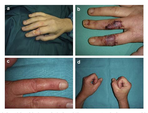 Table 1 From Management Of Full Thickness Skin Defects In The Hand And Wrist Region First Long
