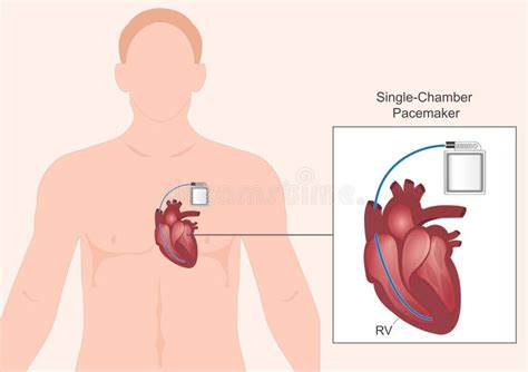 Single Chamber Pacemaker Type Of Pacemaker Stock Illustration