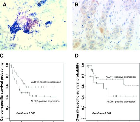 Aldh1 Overexpression Is Associated With Aggressive Biological Behavior
