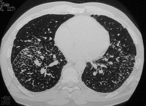 Sarcoidosis Perilymphatic Nodules Are Interstitial Nodules Usually Well Defined Which Are