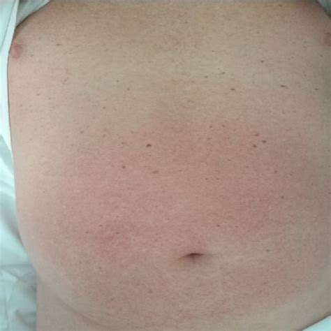 Diffuse Itchy Maculopapular Rash Download Scientific Diagram