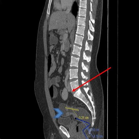 Ct Scan Of The Abdomen And Pelvis Sagittal View Showing The Upper Download Scientific Diagram