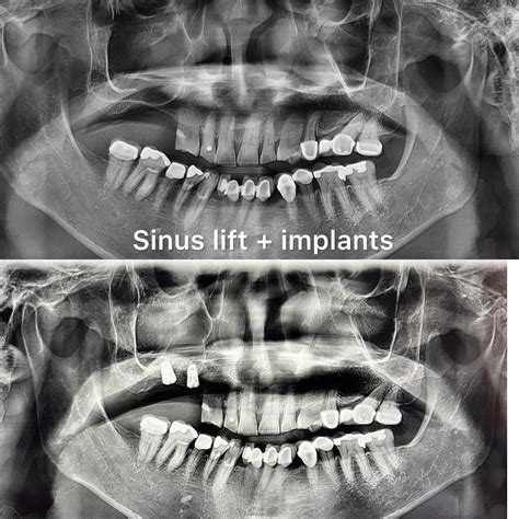 Lesmile Lesmile Dental Clinic 鼻竇抬昇—側窗法＋植牙 Lateral Sinus Lift And Two