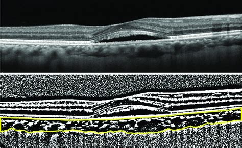 Binarization Of An Oct Image In A Patient With Csc A Representative Download Scientific