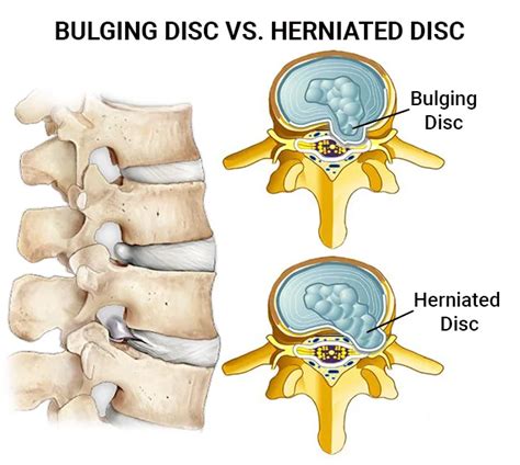 Bulging Disc Vs Herniated Disc Whats The Difference What Causes