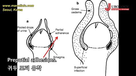 Sleeve Technique Circumcision V Dissection Of Preputial Adhesions 소매법