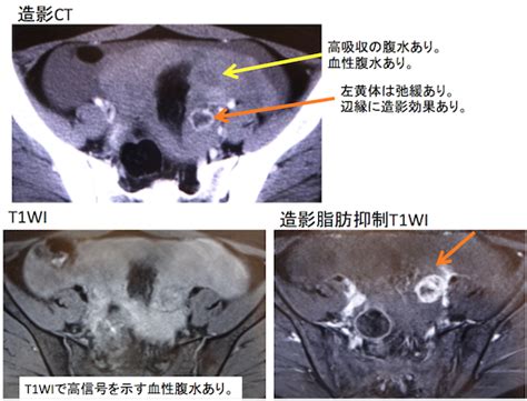 卵巣成熟嚢胞性奇形腫とは？mri画像診断のポイントは？