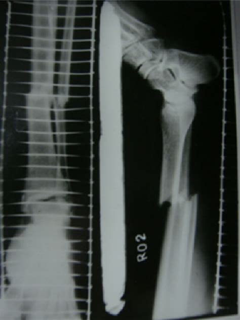 Preoperative X Ray Download Scientific Diagram