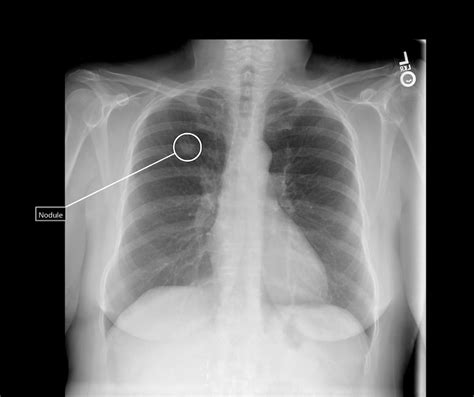 Fda Clears Ai Software For Enhanced Lung Nodule Detection On Chest X Rays