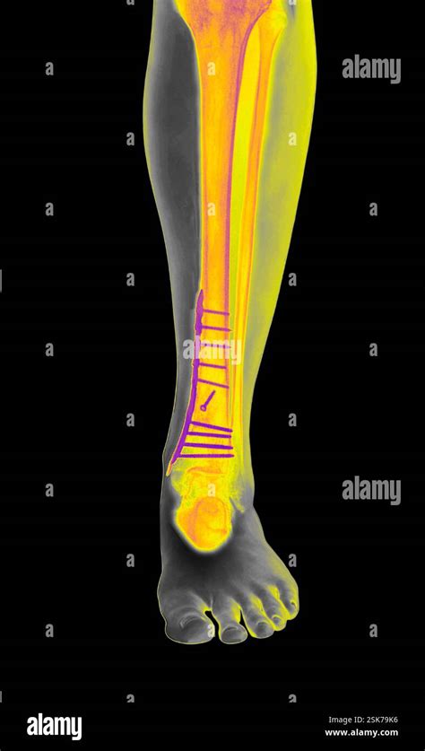 Pinned Fractured Leg Coloured X Ray Of The Lower Leg Of A 26 Year Old Male Patient With A