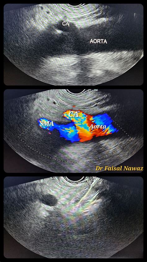 Faisal Nawaz On Linkedin Eus Guided Coeliac Plexus Block Using An Echotip Ultra 22g Fna Needle