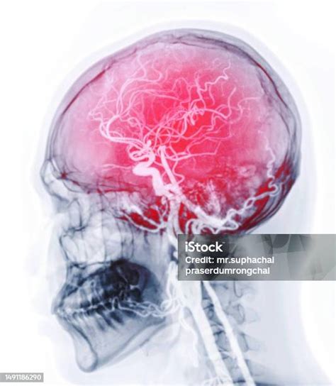 Photo Libre De Droit De Cta Cerveau Ou Ct Angiographie Du Cerveau 3d Rendu De Fusion Dimage Avec
