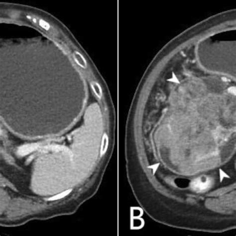 Contrast Enhanced Axial Computed Tomography Scans A Mild Enhancing
