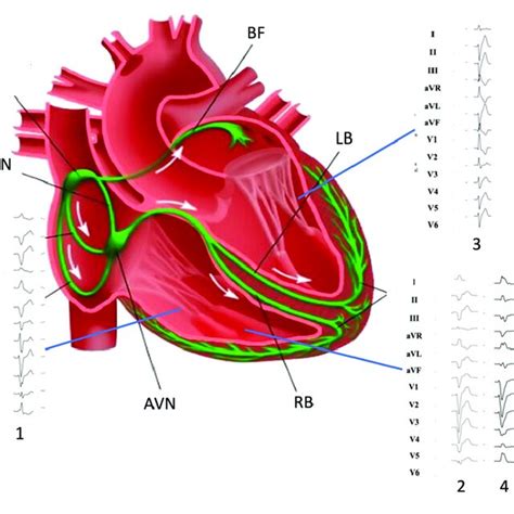 Morphology Of Premature Ventricular Complexes Originating From 1