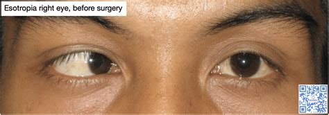 Strabismus Surgery Roque Eye Clinic Ph