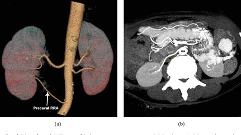 Precaval Lymph Node Semantic Scholar