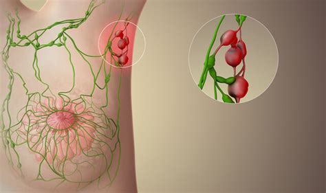Internal Bleeding And Swollen Lymph Nodes Causes Lymph Node