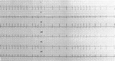 Neonatal And Pediatric Arrhythmias Cardiac Electrophysiology Clinics