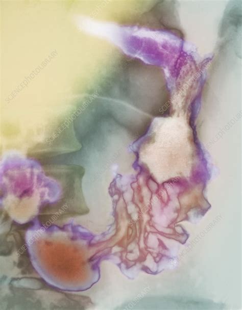 Gastritis X Ray Stock Image M1650218 Science Photo Library