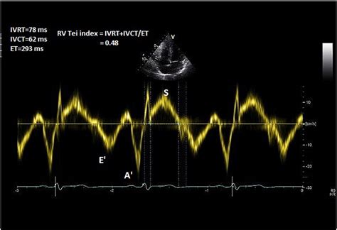 Measurement Of Tei Index Download Scientific Diagram