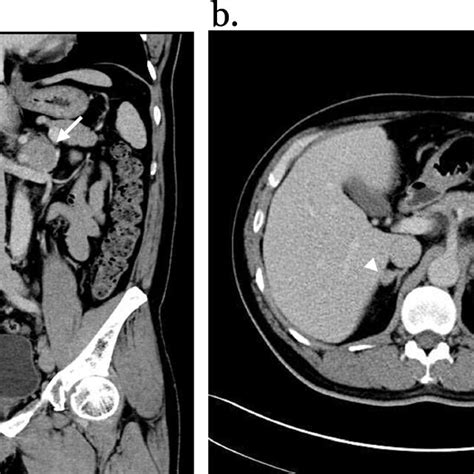 Operative Findings Showed A A 454522 Cm Soft Left Para Aortic Download Scientific