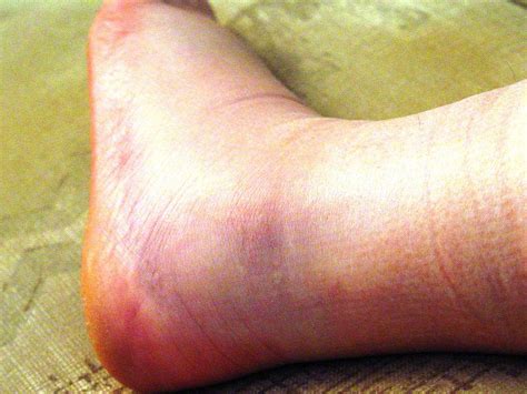 What Does A Stress Fracture In The Fibula Feel Like