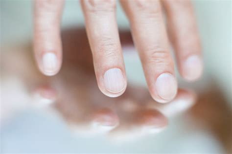 Iron Deficiency Anemia Nails