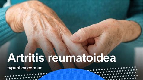 ¿qué Es La Artritis Reumatoidea Y Cómo Detectarla En Casa Salud Youtube