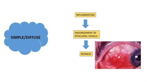 Episcleritis And Scleritis Pptx