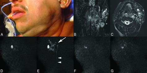 Mr Angiographic Guided Percutaneous Sclerotherapy For Venous Vascular Malformations A Radiation