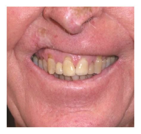 A Lip Lesion Treated Successfully With Definitive Radiotherapy But