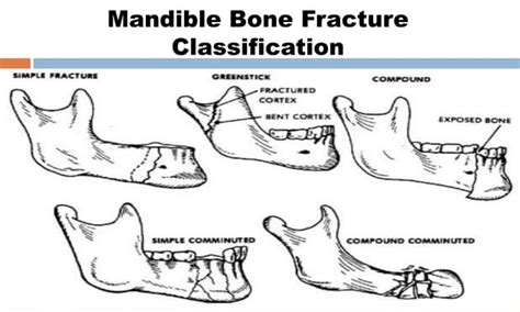 Cranial And Facial Fractures Pptx