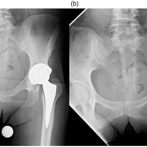 A B Postoperative X Ray Of The Prosthesis Download Scientific Diagram