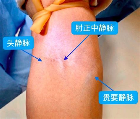 争议！采血管抽血顺序到底哪个先？一文搞定静脉采血11个问题！ 静脉采血的最佳操作 静脉血液标本采集指南 抽血 新浪新闻