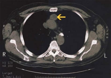 Mediastinal Diseases And Masses Thymoma Department Of