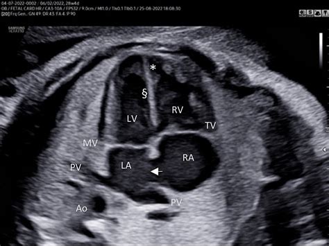 Ultrasound Evaluation Of Normal Second Trimester Fetal Anatomy Article Glowm