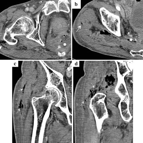 73 Year Old Man With Rectal Cancer Radiation And Chemotherapy